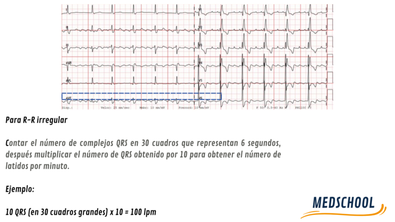Cómo Calcular la Frecuencia Cardíaca en un Electrocardiograma: Guía ...